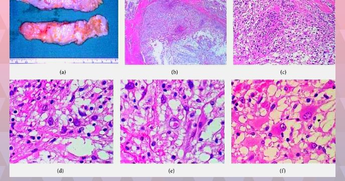 Pathology Infographics : Pathology of Myxoinflammatory Fibroblastic ...
