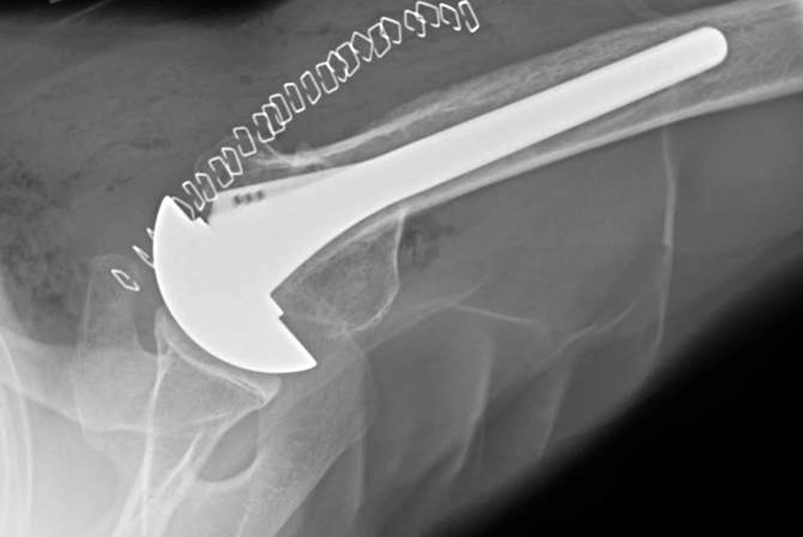 UW Shoulder and Elbow Academy: Shoulder joint replacement - selecting ...