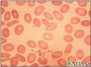 Fichero de Hematología: Anormalidades Eritrositarias.