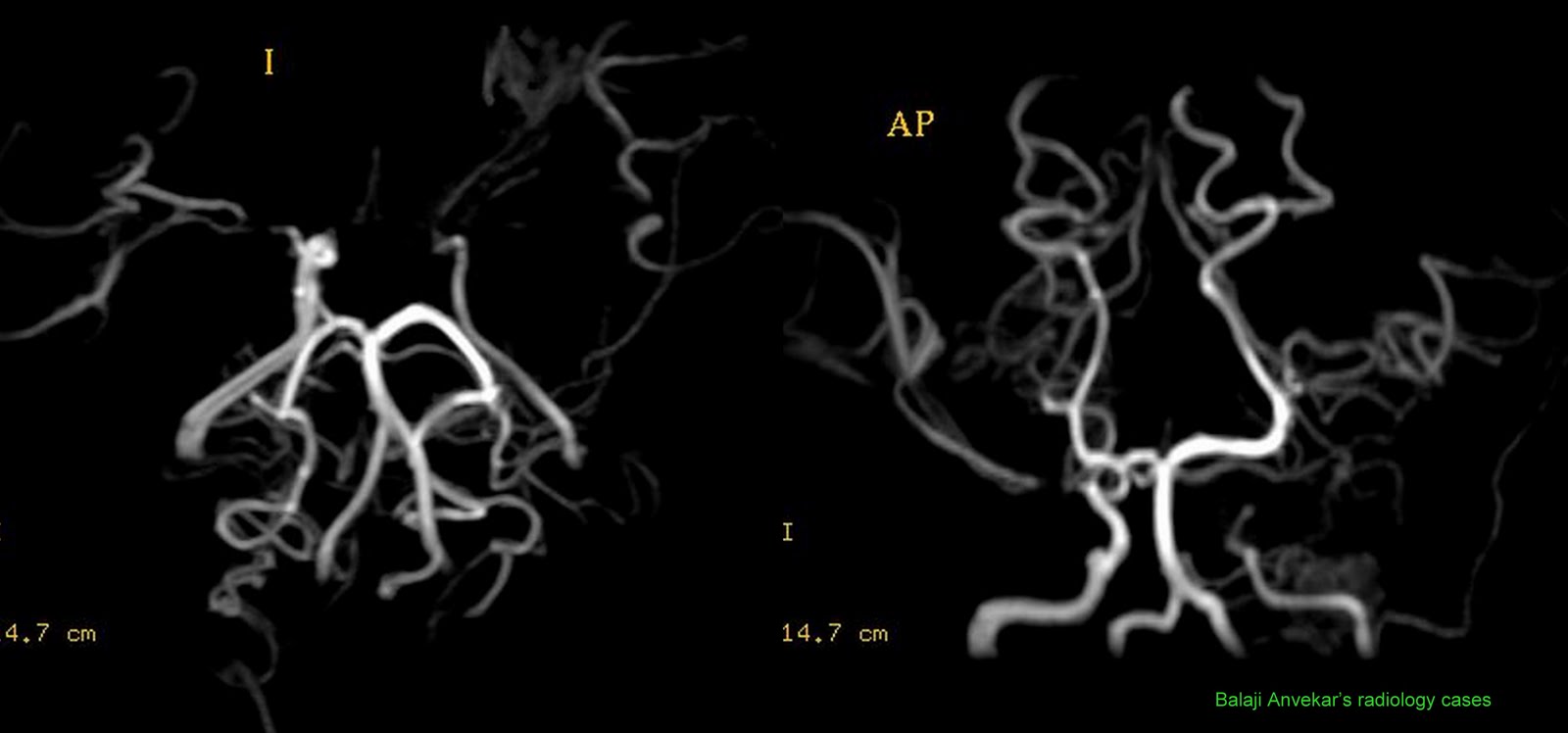 Dr Balaji Anvekar FRCR: IVY sign Moyamoya disease MRI