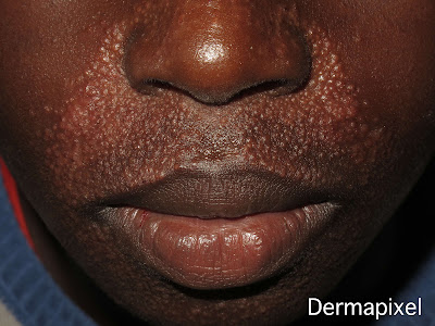 Dermapixel: Un acné muy extraño