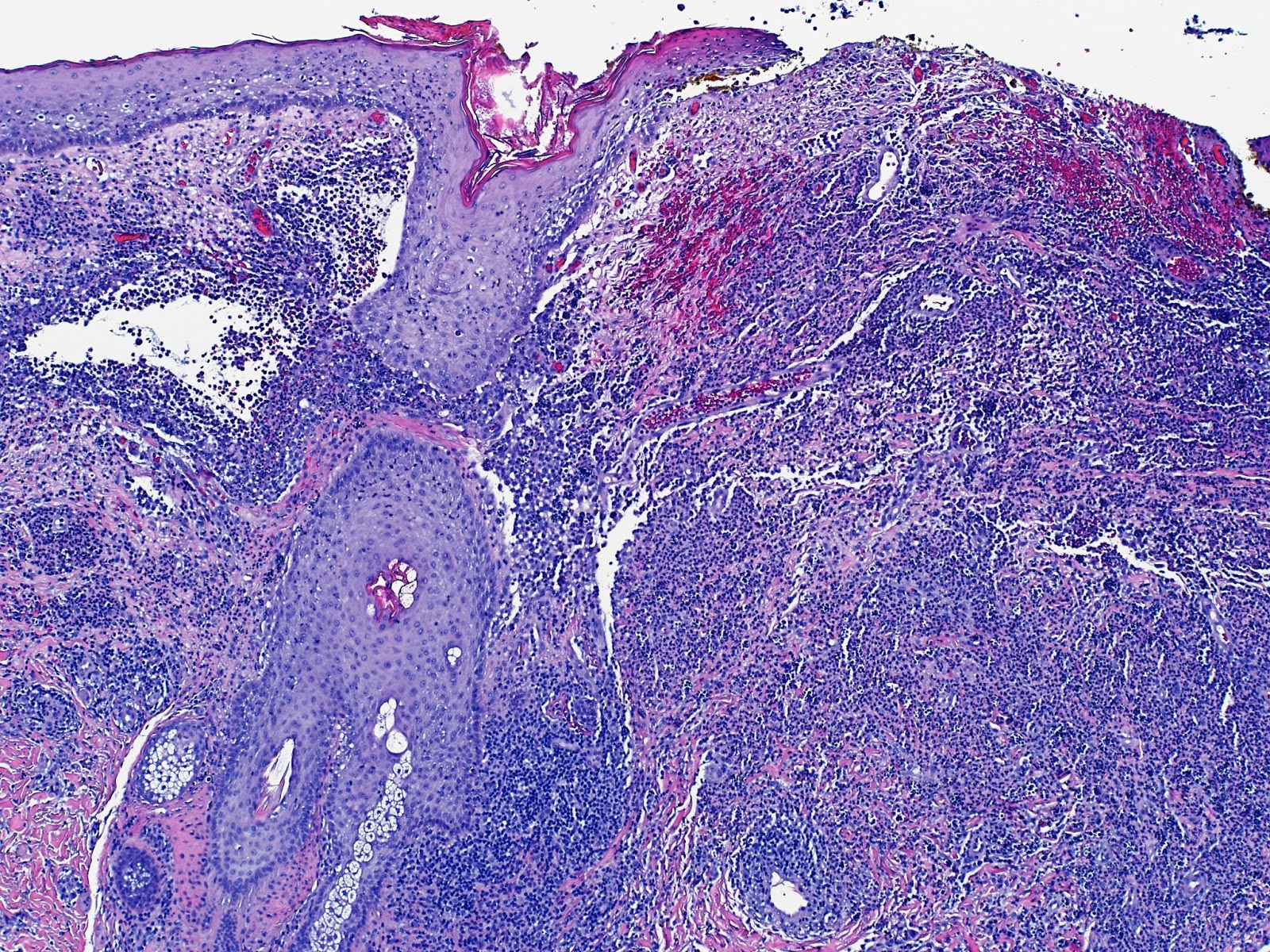 VIRTUAL GRAND ROUNDS IN DERMATOLOGY 2.0: Chronic Localized Folliculitis
