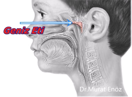 Enlarged Adenoids - Symptoms, Causes, Diagnosis and Treatment