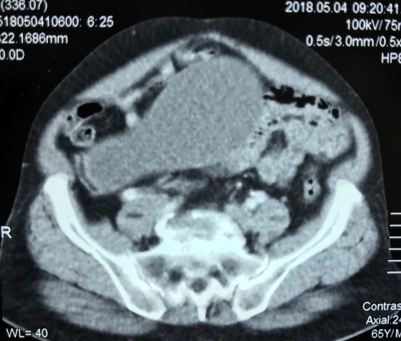VIETNAMESE MEDIC ULTRASOUND: CASE 492 : APPENDICULAR MUCOCELE, Dr PHAN ...