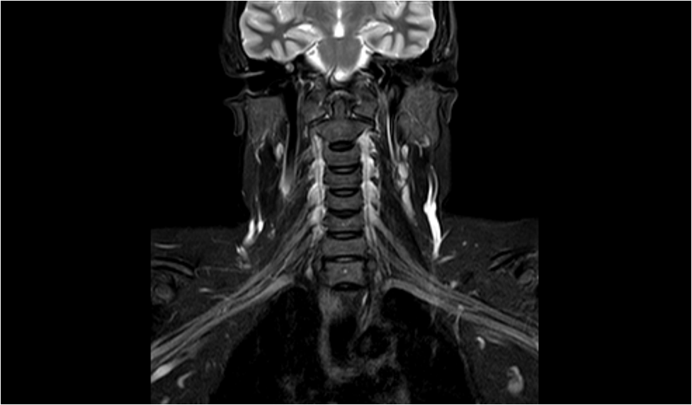 Chronic Inflammatory Demyelinating Polyradiculopathy CIDP MRI Sumer