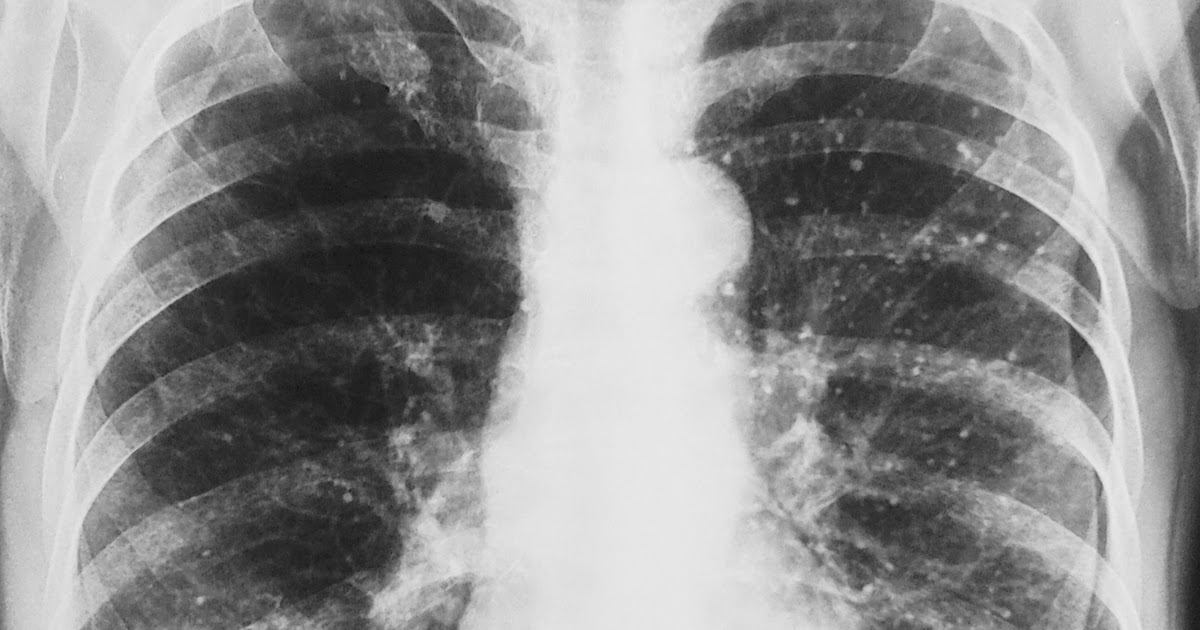 Radiodiagnosis - Imaging is Amazing-Interesting cases: Healed Varicella ...