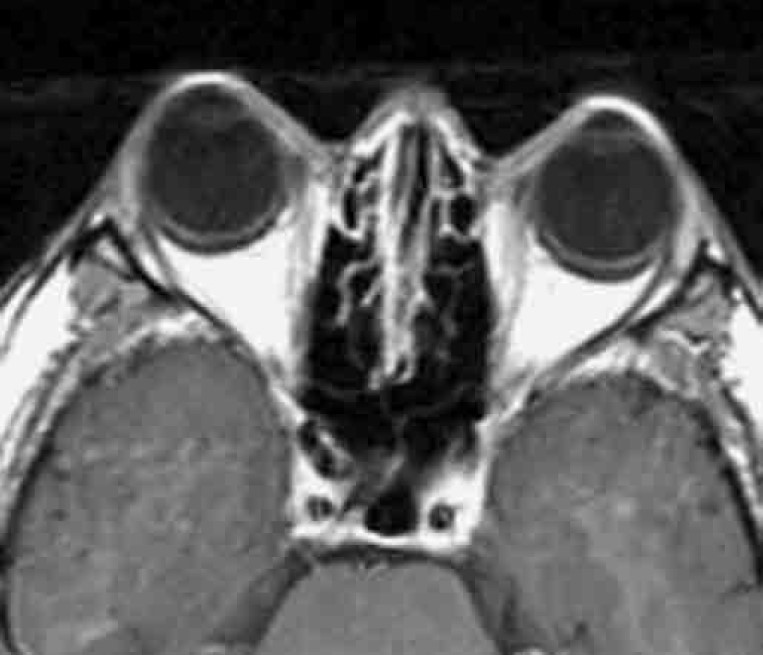 Dr Balaji Anvekar FRCR: Artifact from Eye Makeup