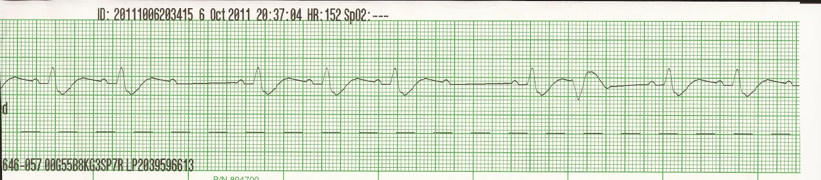 ACLS Rhythms: Heart blocks