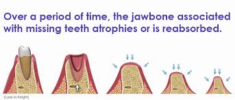 FAMILY CARE DENTAL: What will happened after a tooth is extracted?