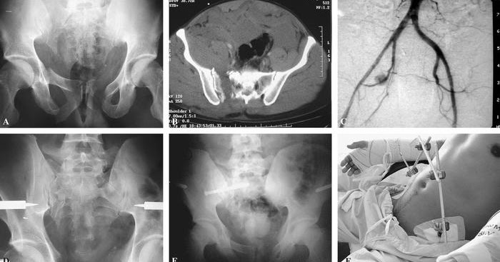 Tecnicos Radiologos: Fractura de Pelvis y de Cadera (todas las ...