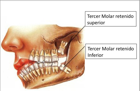 TECNICAS QUIRURGICAS PARA LA EXODONCIA DE TERCEROS MOLARES INFERIORES ...