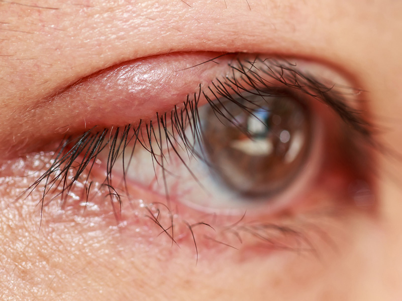 Clínica de Ojos Oftalmic Láser: La blefaritis y la sequedad de ojos