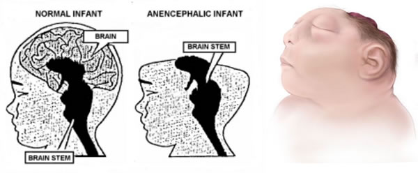 Diario de un técnico: ¿ Qué es la ANENCEFALIA