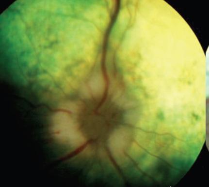 Neuritis: Cranial Neuritis