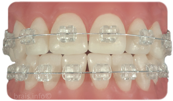 ¡LOS BRACKETS PUEDEN SER DIVERTIDOS! ORTODONCIA PARA TODOS: Brackets
