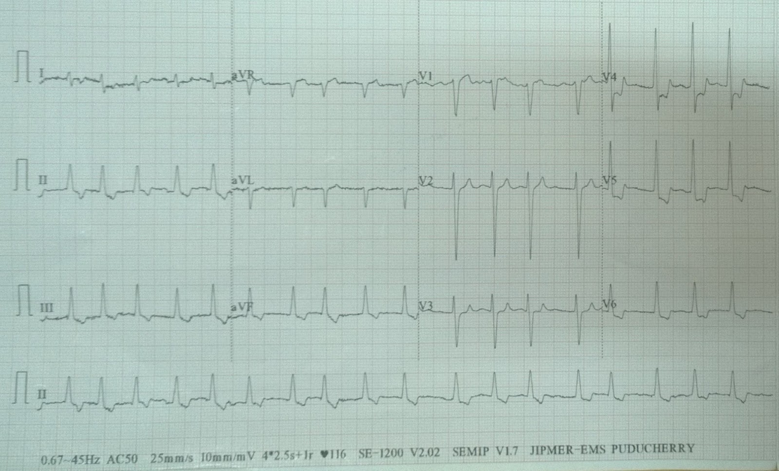 Cardiology window: Atrial fibrillation with digoxin effect