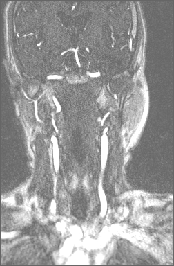 Ultimate Radiology : Fenestration of Left Superior Cerebellar Artery