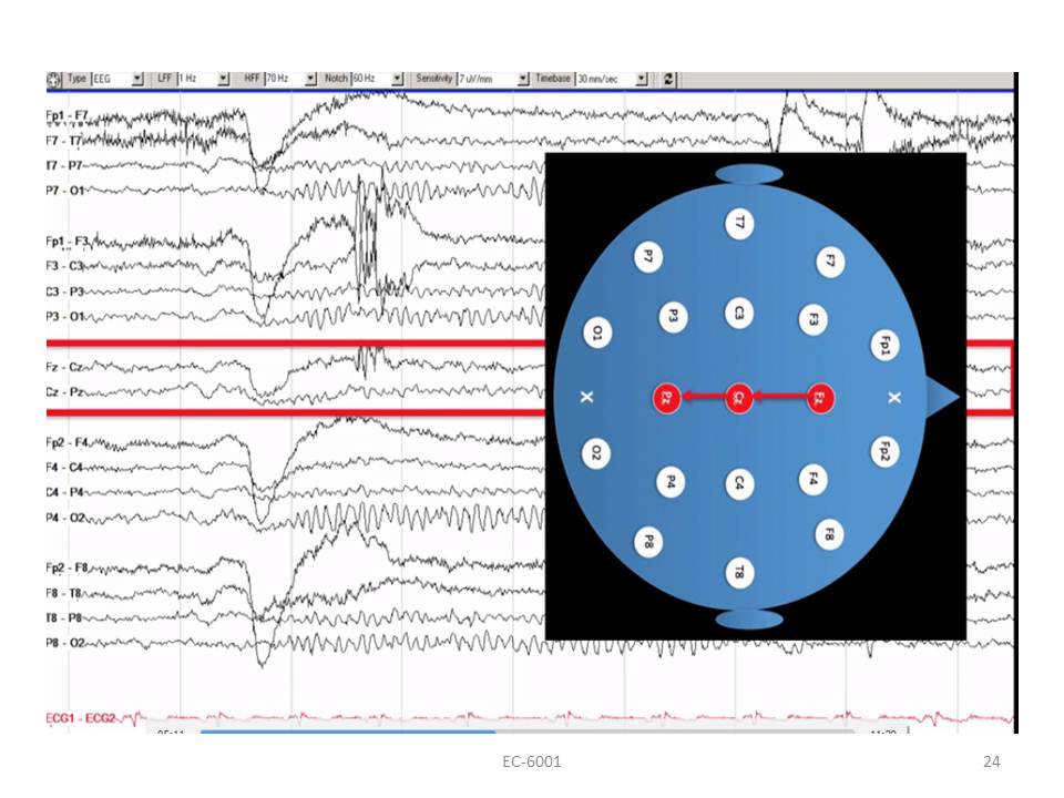 Medical Electronics : EEG recording principles-PPT-reg