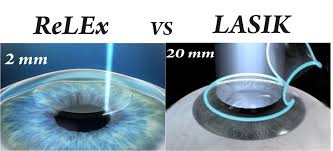 WELCOME TO MY WORLD...: My experience - Lasik at Optimax