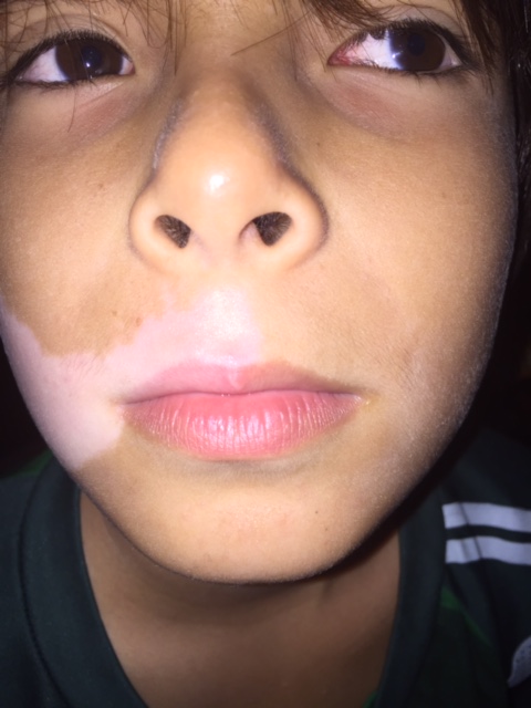 VIRTUAL GRAND ROUNDS IN DERMATOLOGY 2.0: Unilateral/Segmental Vitiligo ...