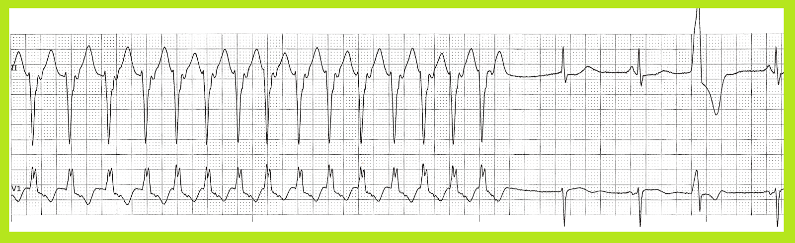 Various Ventricular Tachycardias
