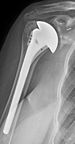 UW Shoulder and Elbow Academy: The humeral implant - how to fix it to ...
