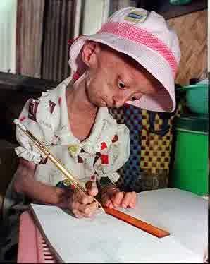 PENYAKIT PENUAAN DINI ATAU PROGERIA - BLOG APA AJA