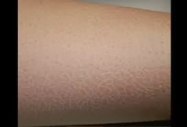 Pelle Secca: Rimedi fai da te per risolvere il problema - Dermatologo a ...