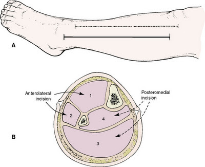 骨科筆記: FASCIOTOMY