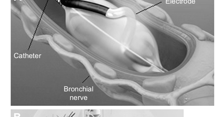 内科開業医のお勉強日記: COPDへのTargeted lung denervation (TLD) 治療 3年間効果続く