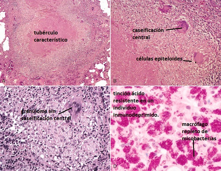 PATOLOGÍA HUMANA: VÍAS DE DISEMINACIÓN DE LA TUBERCULOSIS