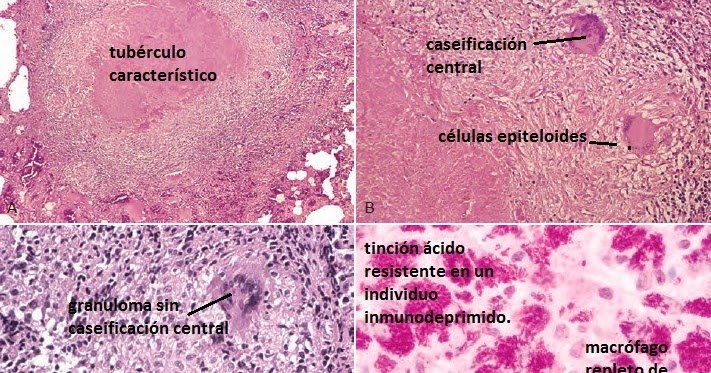 PATOLOGÍA HUMANA: VÍAS DE DISEMINACIÓN DE LA TUBERCULOSIS
