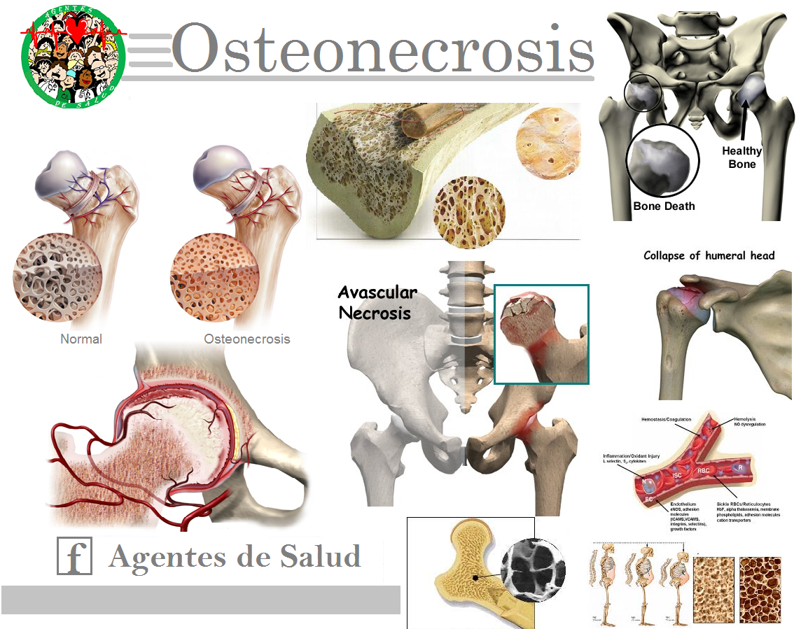 Agentes de Salud: Osteonecrosis