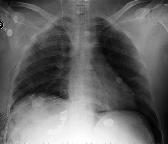 Tecnicos Radiologos: Signo del surco profundo en Neumotórax