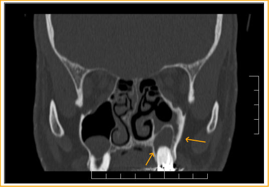 Odontogenous maxillary sinusitis-CT - Sumer's Radiology Blog