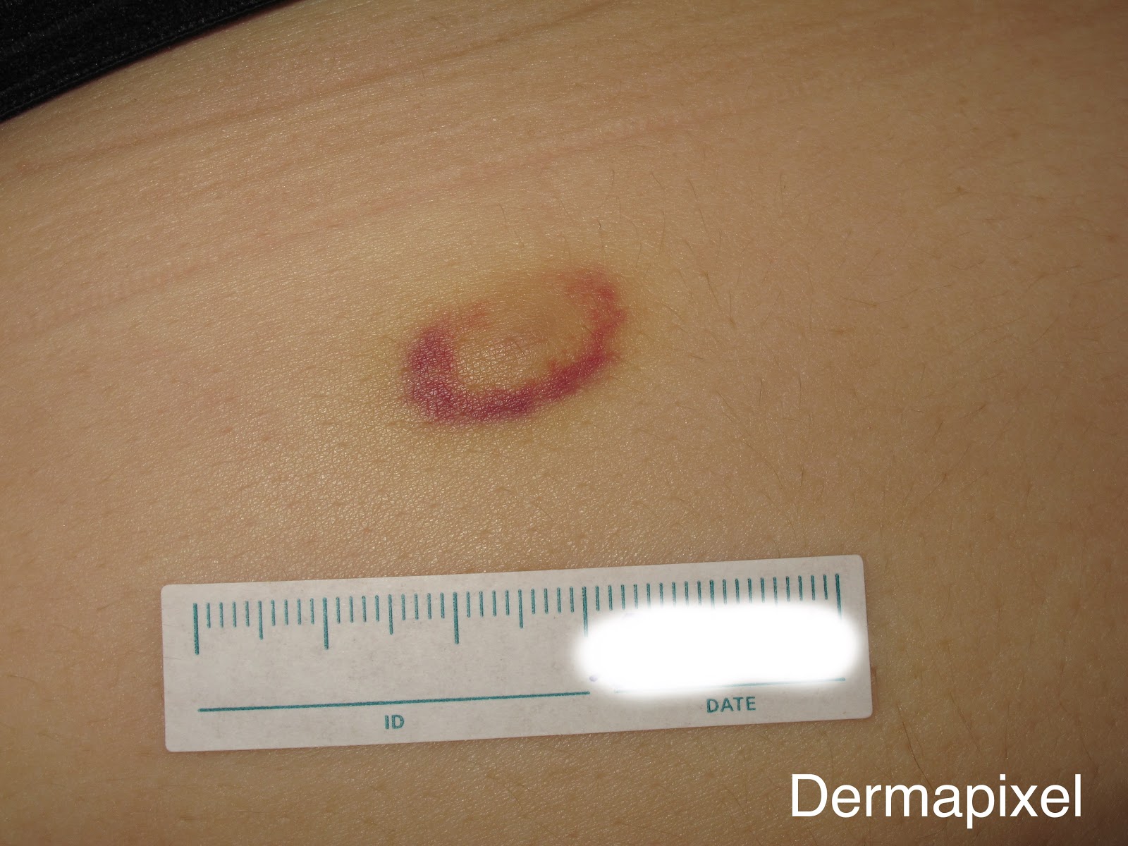 Dermapixel: Rojo, lila y amarillo