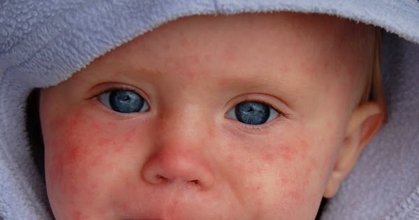 About Health: Measles