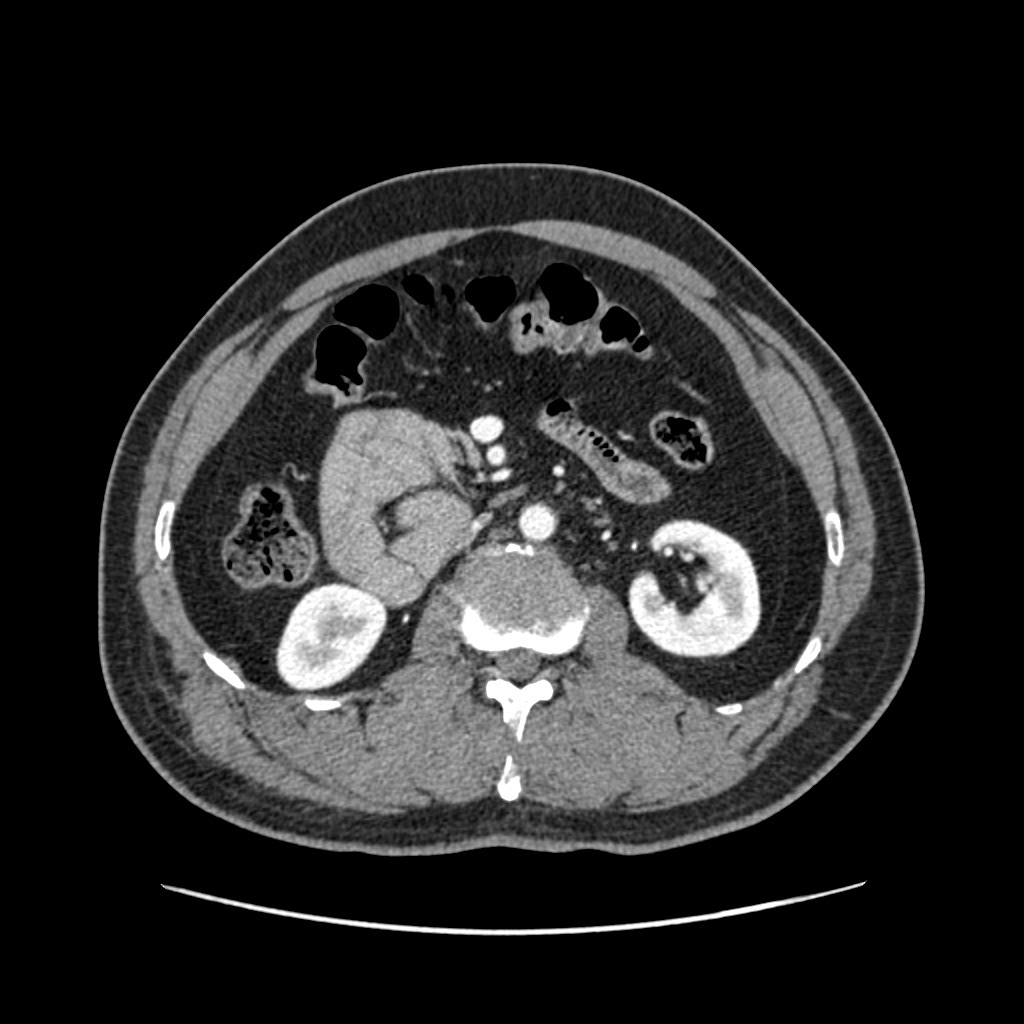 Radshare: PARTIAL MIDGUT MALROTATION