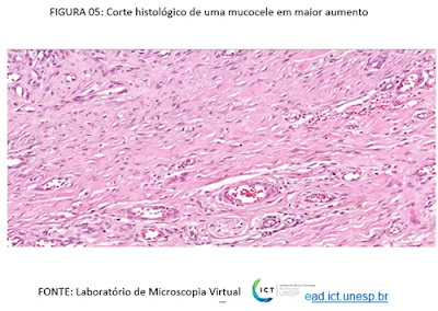 Atlas virtual de histologia e patologia: [CC II: #4] MUCOCELE