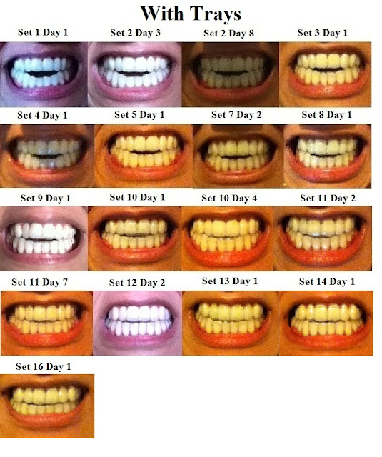 Invisalign For Severe Anterior Open Bite - My Pictures and Story: What ...