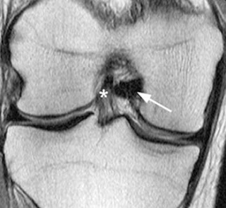 Radiology Channel: Anatomy of bundles of ACL and PCL.
