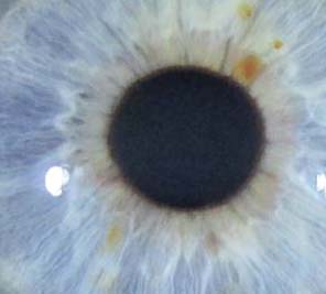 Modern & Multidimensional Iridology: Crypts, Radial Furrows & Pigment ...