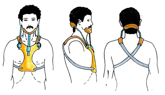 Hanging Arm Cast For Humerus Fracture