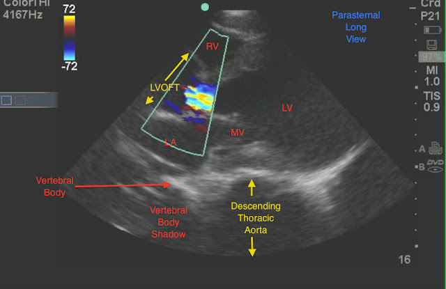 Aortic Dissection with Acute Aortic Regurgitation ~ Ultrasound Cases Info