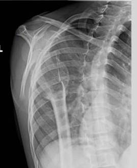 Exostosis-not always easy to identify! - Sumer's Radiology Blog