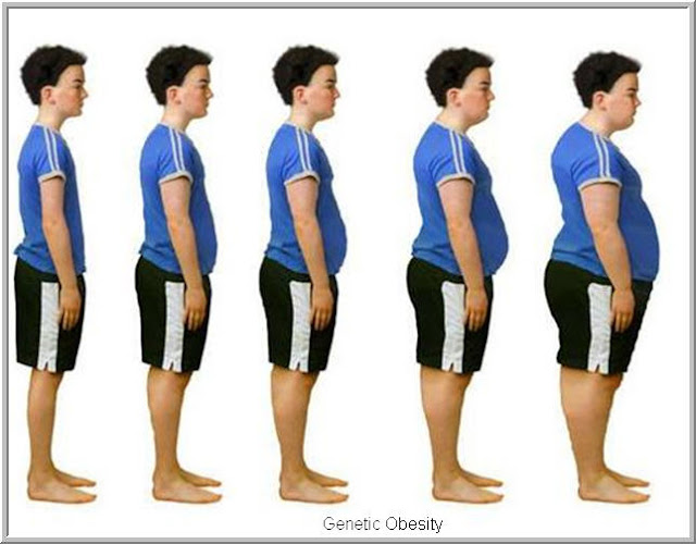 OBESITY: CAUSES, SYMPTOMS AND TREATMENT | S T R A V A G A N Z A