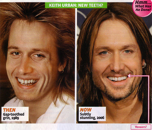 Chatter Busy: Keith Urban Plastic Surgery