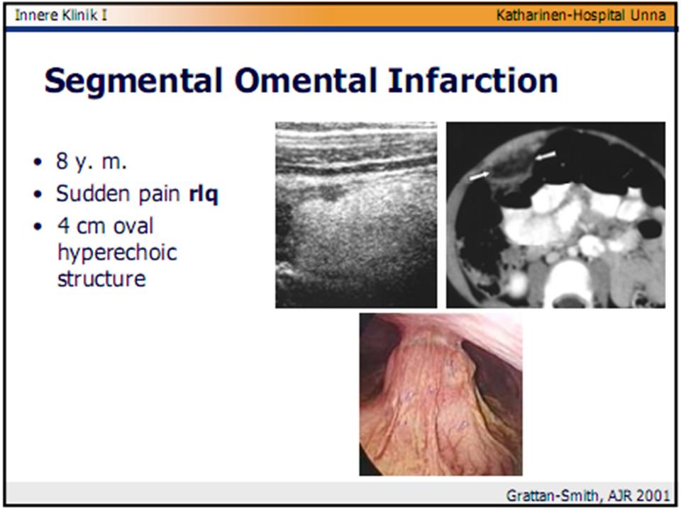 BÀI SOẠN VỀ SIÊU ÂM CHẨN ĐOÁN: NHÂN CA PRIMARY OMENTUM TORSION ở MEDIC