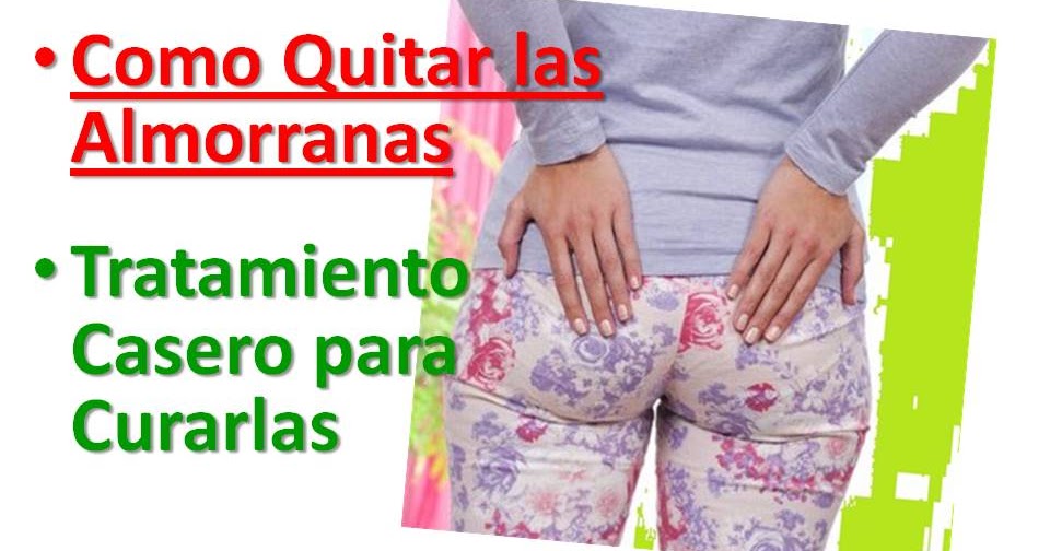Cómo Quitar las Almorranas Externas sin Cirugía: Tratamiento Casero ...
