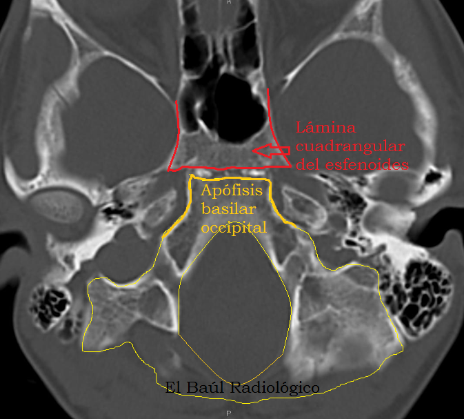 El Baúl Radiológico: SINCONDROSIS ESFENOBASILAR. (Sphenobasilar ...